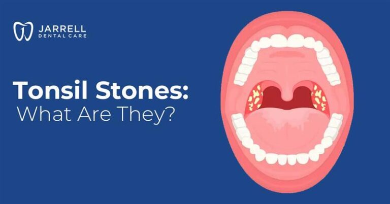 Tonsil Stones: What Are They? | Jarrell Dental Care
